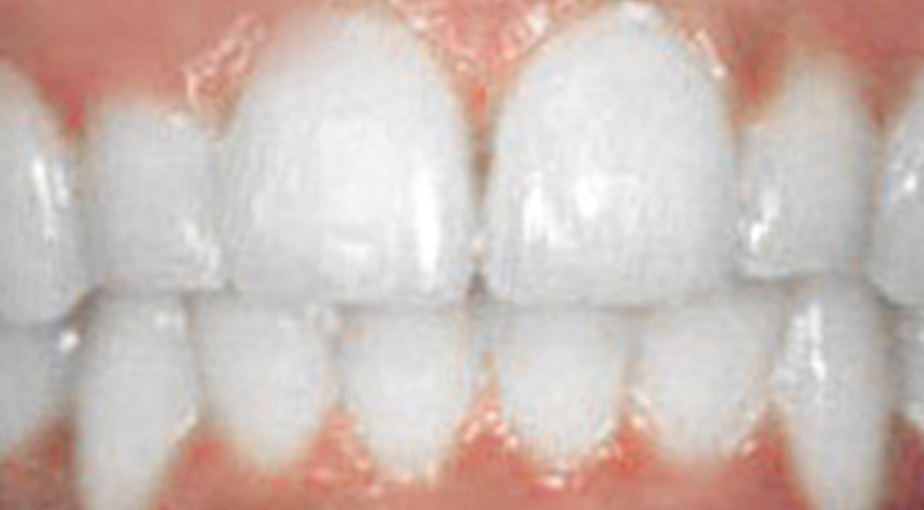 Fastbraces® - Idaho Falls ID | Park West Dental Care