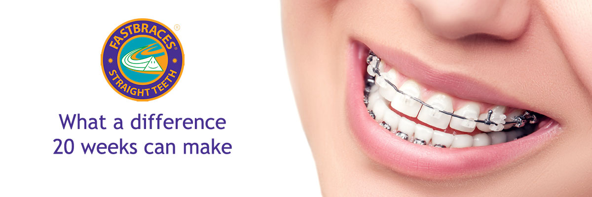 Fastbraces® - Idaho Falls ID | Park West Dental Care